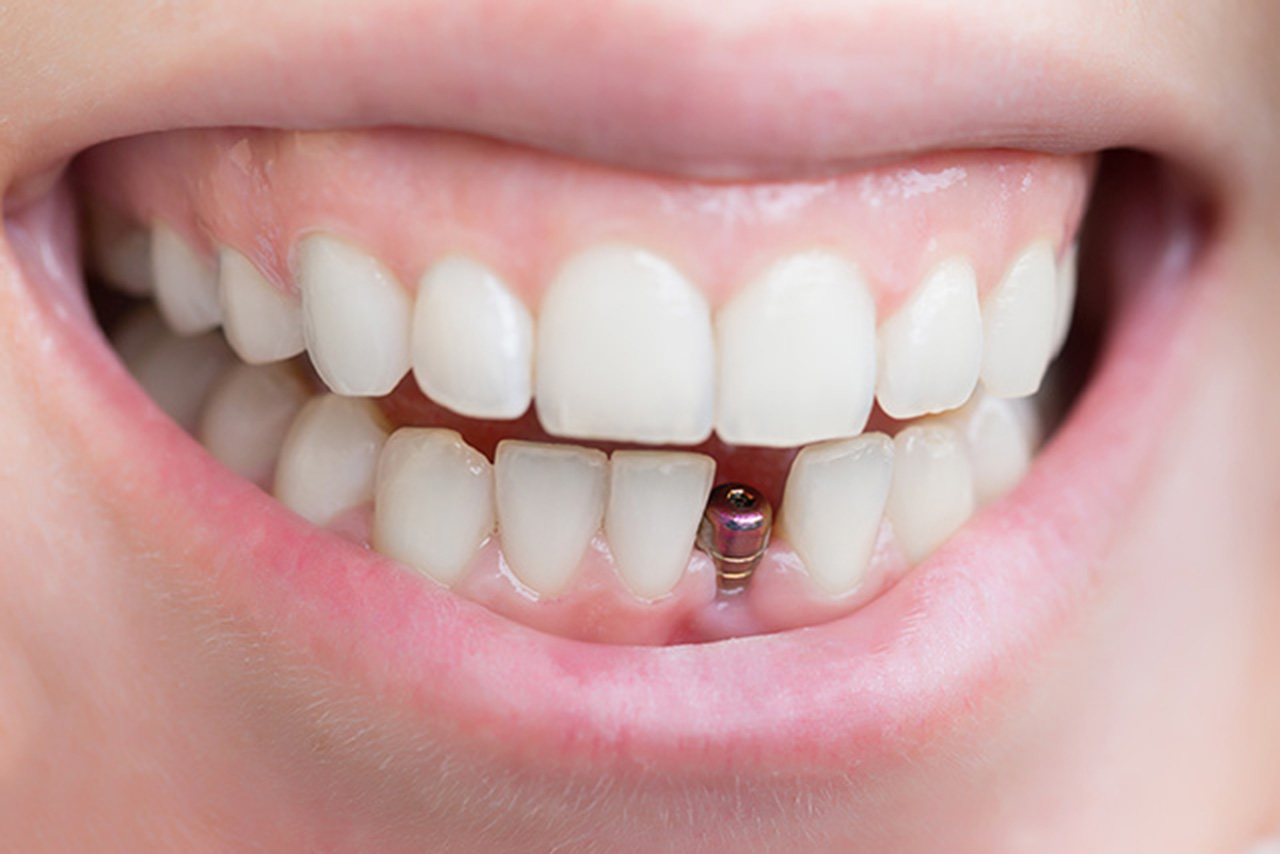 How To Get Front Tooth Replacement - Integrative Medical Alliance