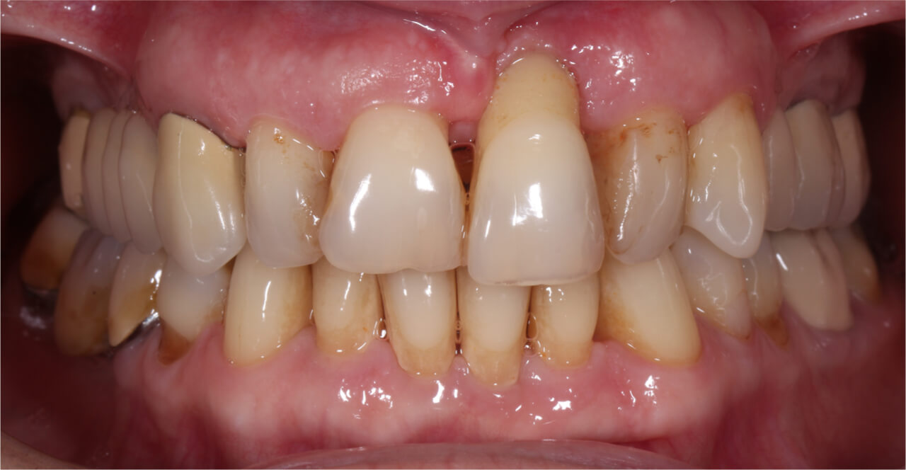 See images of gum disease to identify if you suffer from it